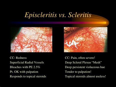 Conjunctivitis Vs Scleritis Scleritis Vs Episcleritis Vs