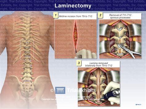 Laminectomy