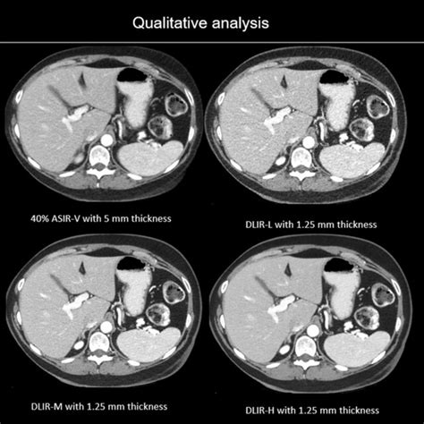 Clinical Examples In The Same Patient With Four Different Reconstructed Download Scientific