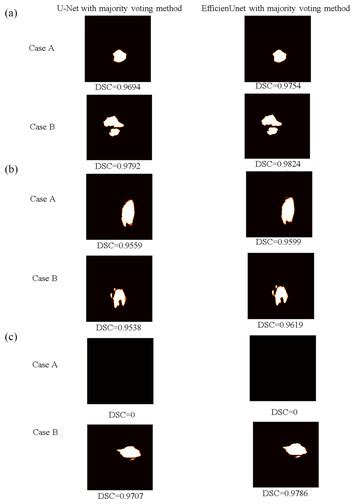 Brain Tumor Segmentation Using U Net In Conjunction With Efficientnet