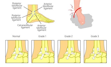Ankle Sprain Grade