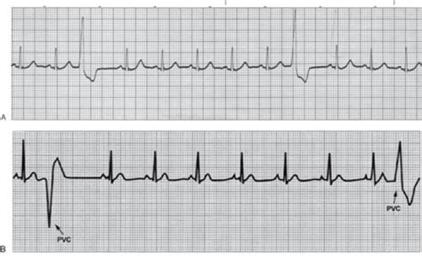 Ventricular Dysrhythmias Final Flashcards Quizlet