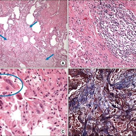 A Chest X Ray Shows Patchy Nodular Ground Glass Opacity Infiltrations Download Scientific