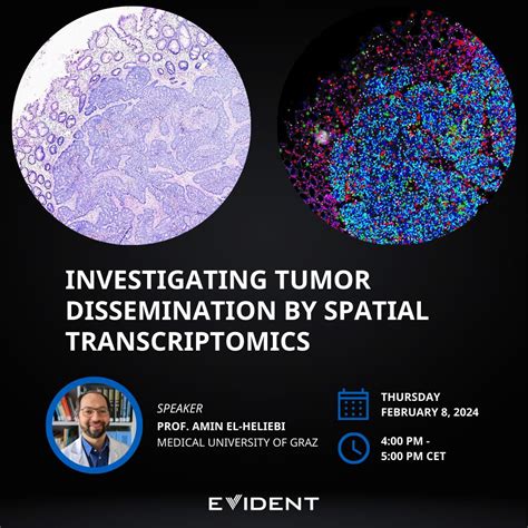 Webinar On Tumor Dissemination By Spatial Transcriptomics Evident