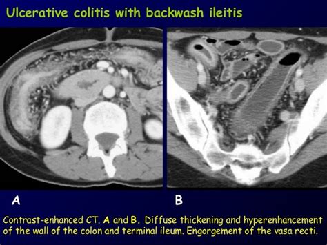 Ulcerative Colitis Imaging