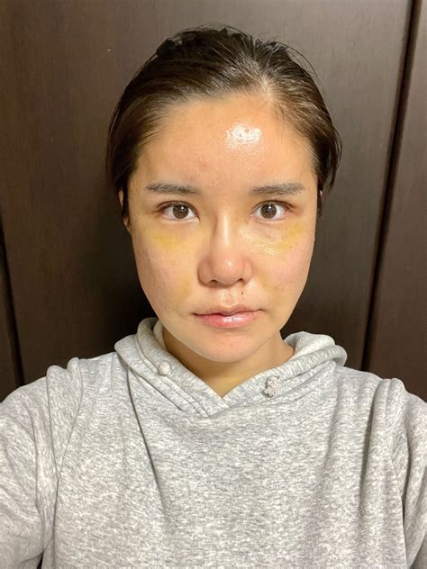 100日後に可愛くなる🏥みさちゃす💄 On Twitter まさかさ、顔を整形したらダウンタイムで小室圭さんに似るとは思わなかったよね