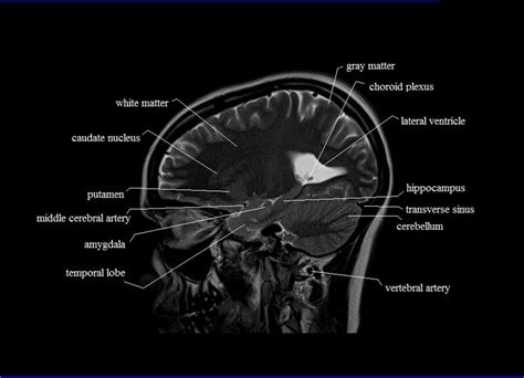 Cross Sectional Anatomy Mri Brain Sagittal Anatomy Free Mri Brain