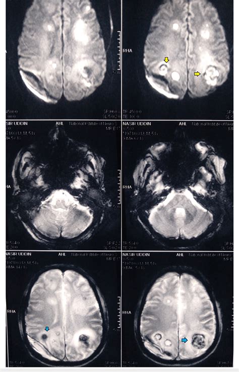 Mr Perfusion Scan Shows Diffusion Restriction In Dwi Yellow Arrow And