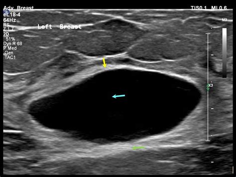 Breast Cyst Ultrasound Value Of Hand Held Ultrasound In The