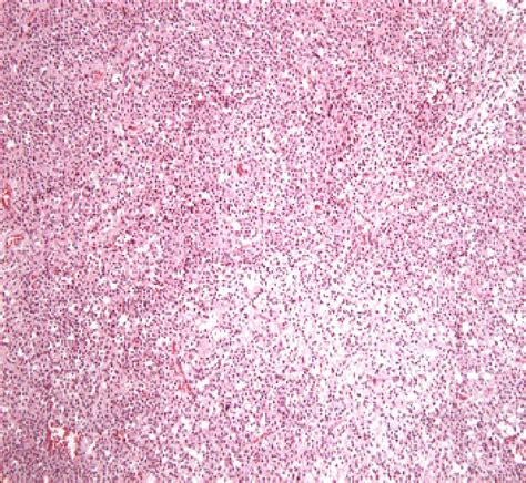 On The Low Powered Magnititude The Tumor Shows Irregularly Alternating