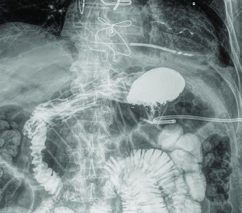 Upper Gi Series Showing No Evidence Of Contrast Extravasation Following