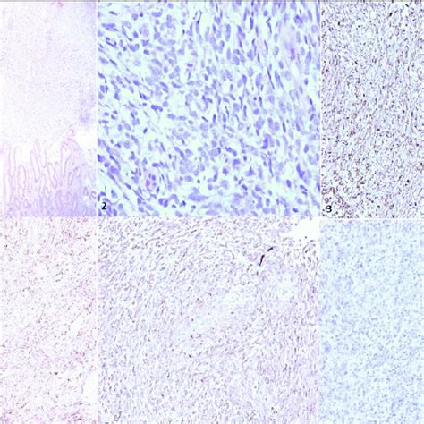 Malignant Looking Ulcer With Rolled Up Edges And Fungating In Nature At Download Scientific