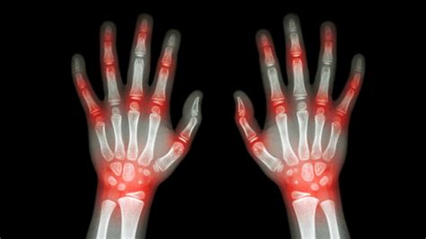 How Hand Therapy Can Help Manage Arthritis Related Hand Pain Hands