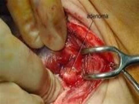 Hyperparathyroidism Types And Management Pptx