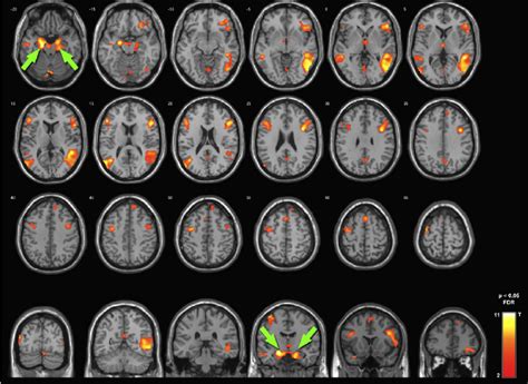 fmri group analysis of 7 t dataset second level group analysis t