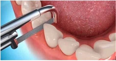 Ipr In Aligners My Line Aligner