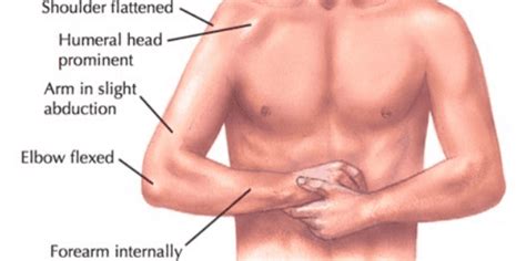 Do I Need Dislocated Shoulder Surgery Orthopaedic Specialists