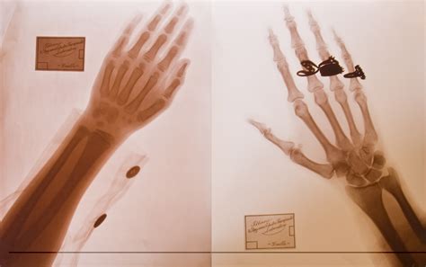 X Ray Hair Removal Seeing Through The Beauty Industry International Museum Of Surgical Science