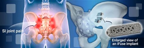 Si Joint Dysfunction X Ray At Karan Katz Blog