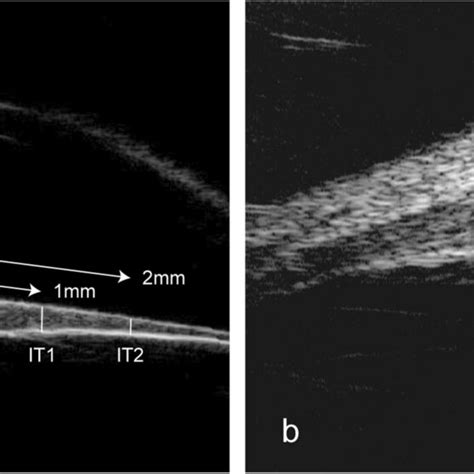 Details Of Measurement Of The Anterior Chamber Parameters A Iris