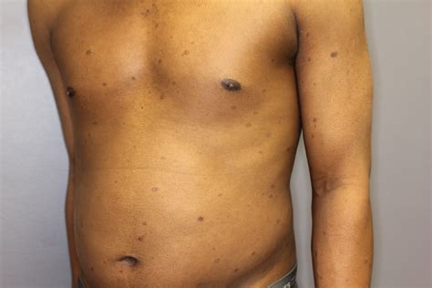 Сифилис Медицинский факультет