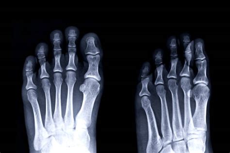 Normal Right Foot Xray