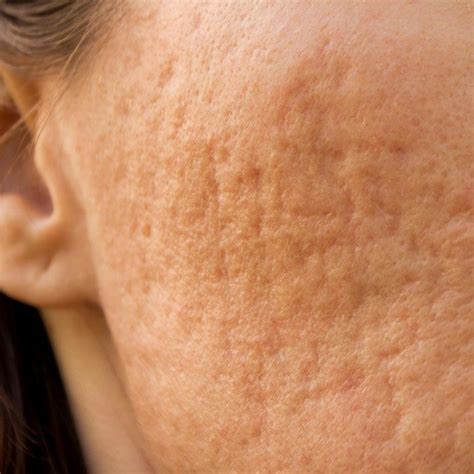 What Are Rolling Acne Scars Best Acne Scar Treatment Of 2024