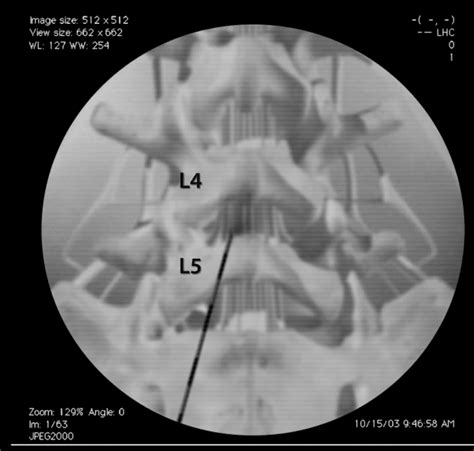 Lumbar Epidural Steroid Injection Florida Surgery Consultants