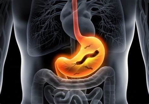 Helicobacter Pylori H Pylori Stomach Infection Dtap Clinic