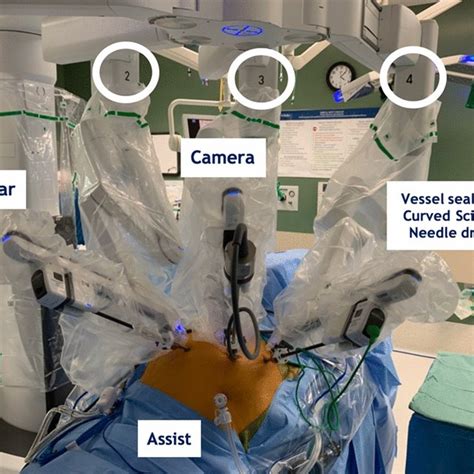Rectosigmoid Segment Separated From The Mesentery Download Scientific Diagram