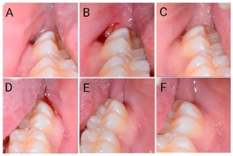 How To Speed Up Wisdom Teeth Recovery Expert Tips For A Faster Healing