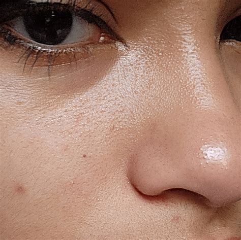 Bumpy Texture Around Eyes And Nose Rskin