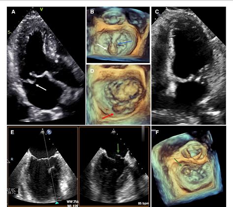 Figure 2 From Quantification Of Primary Mitral Regurgitation By
