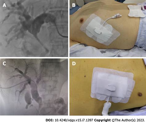 Different Percutaneous Transhepatic Biliary Stent Placements And