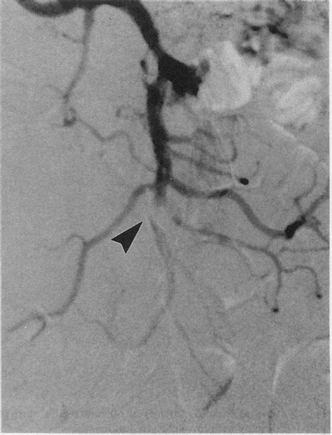 Arteriogram Showing Embolus In Distal Superior Mesenteric Artery