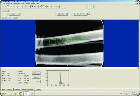 Radiographic Bone Density Measurement Download Scientific Diagram