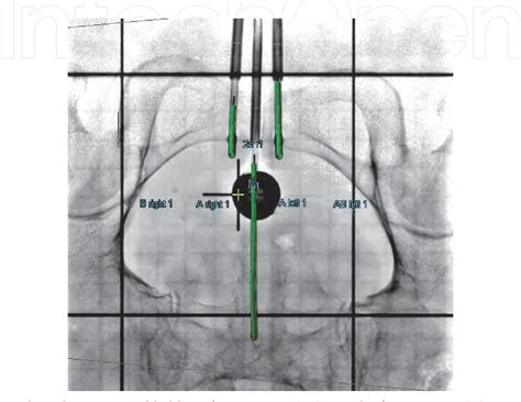 Figure 1 From Ct Guided Brachytherapy Planning Semantic Scholar