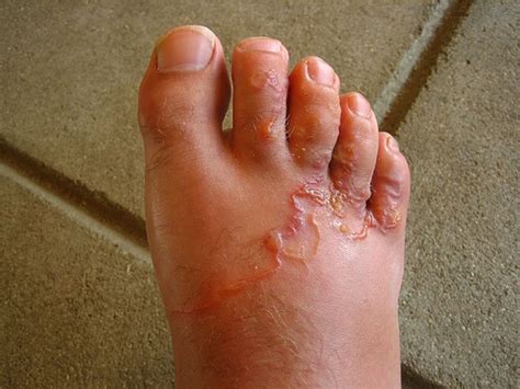 Infection Landscapes Hookworm