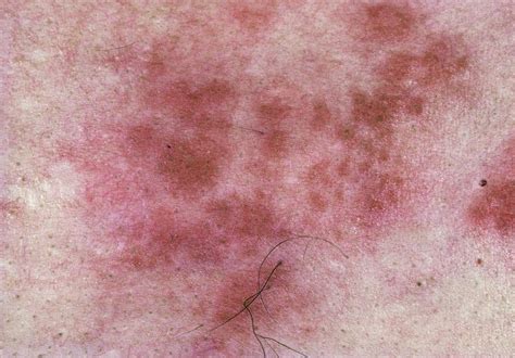 Shingles Rash From Herpes Zoster Infection Photograph By Science Photo