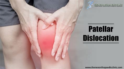 Patellar Instability Or Patellar Dislocation Neoorthopaedics On Tumblr