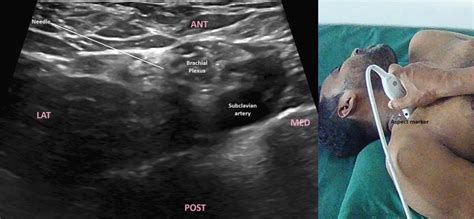 Usg Guided Brachial Plexus Block A Precision Approach