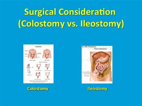 Colostomy Complications