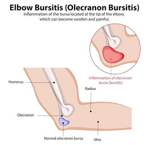 Free Vector Elbow Bursitis Medical Illustration