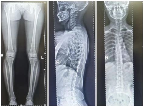Sistema De Fluoroscopia Gastrointestinal Digital Completo Imagens