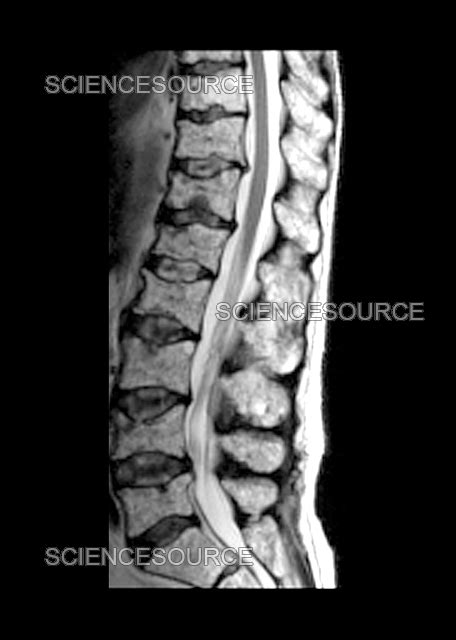 Mri Of Multiple Myeloma Stock Image Science Source Images