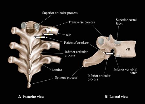 Figure 2 From Ultrasound Guided Multilevel Thoracic Paravertebral Block And Its Efficacy For