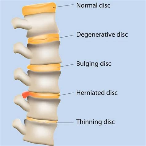 Stl File Spine Defect 🦷 ・3d Printable Model To Download・cults