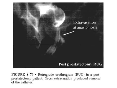 Retrograde Urethrogram Presentation 1 Ppt Pptx