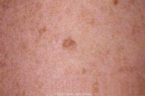 Seborrhoeic Keratosis How To Idenitify Seb K Extensive Gallery