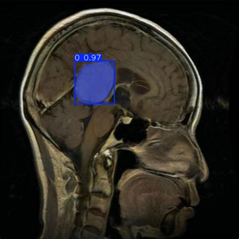 Yolo V11 Tumor Detection Data Roboflow Kaggle